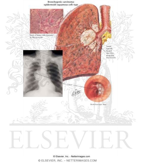 Bronchogenic Carcinoma: Squamous Cell Type
