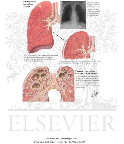 Pulmonary Tuberculosis