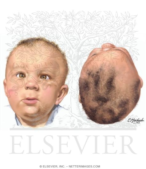 Plagiocephaly