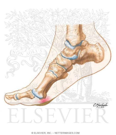Foot Calluses and Ulceration