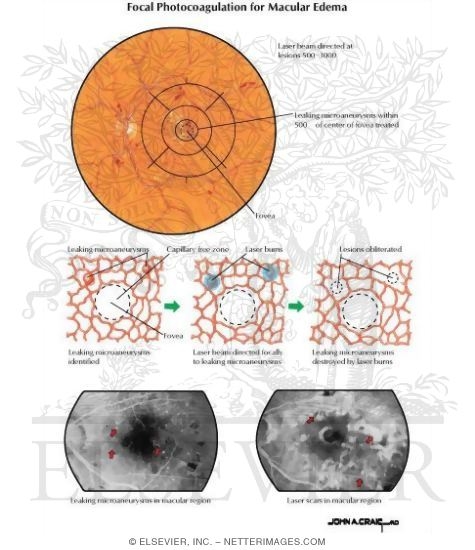 Focal Photocoagulation for Medical Edema