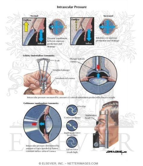 Intraocular Pressure