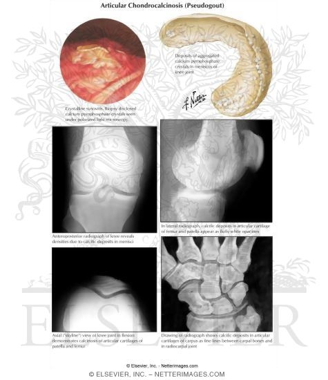 Articular Chondrocalcinosis (Pseudogout)