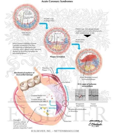 Acute Coronary Syndromes
