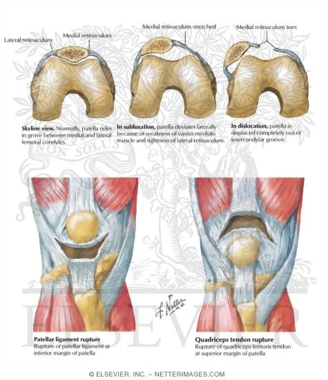 retinaculum tightness