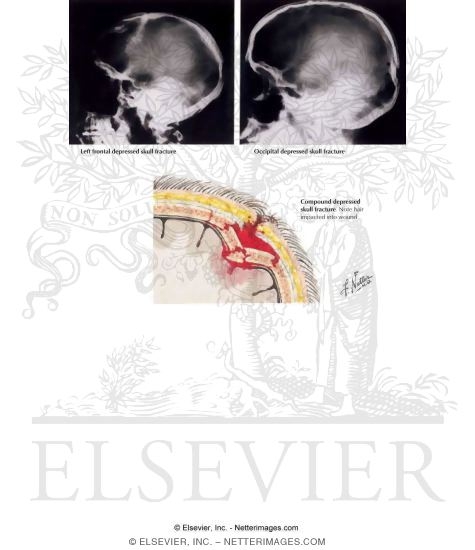 Compound Depressed Skull Fractures