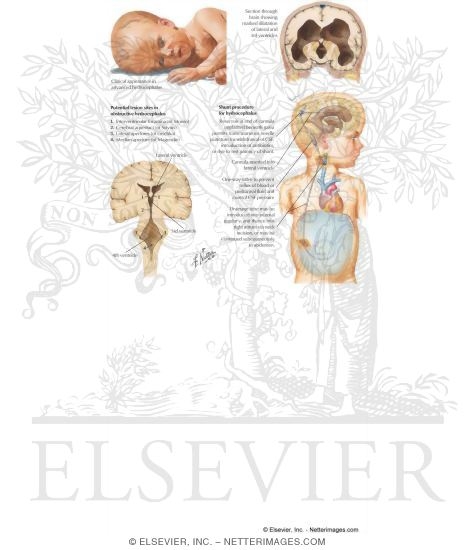 Hydrocephalus