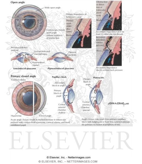 Glaucoma