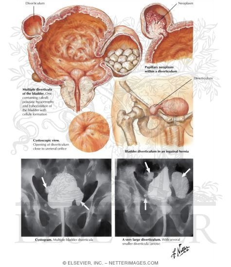 bladder diverticulum
