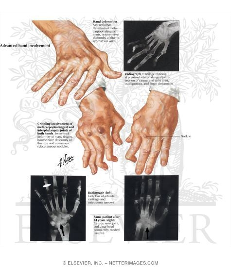 Advanced Hand Involvement in Rheumatoid Arthritis Disorders: Arthritis ...