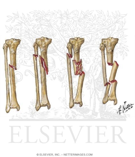 Fracture of Shaft of Tibia