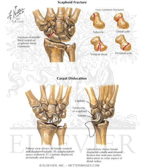 Scaphoid Fracture Carpal Dislocation