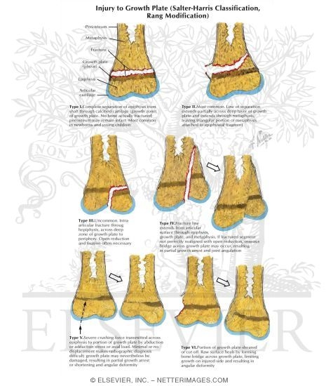 Injury to Growth Plate (Salter-Harris Classification, Rang Modification)
