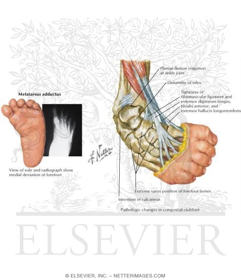Metatarsus Adductus Vs Clubfoot