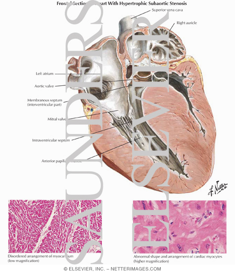 Idiopathic Hypertrophic Subaortic Stenosis