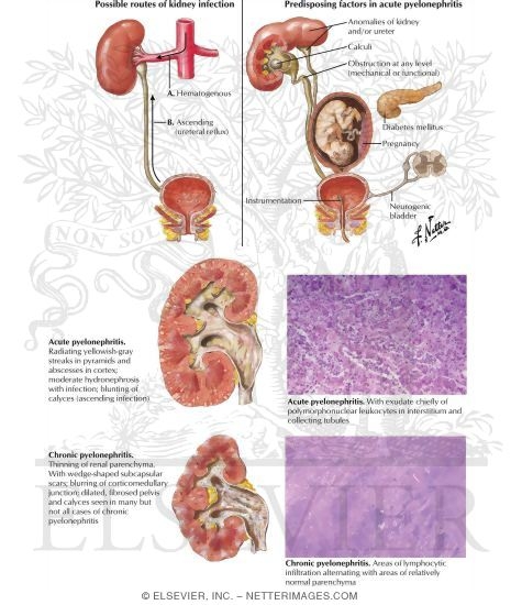 Pyelonephritis