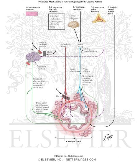 Postulated Mechanisms of Airway Hyperreactivity Causing Asthma