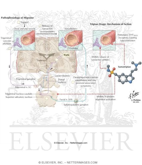 Pathophysiology of Migraine