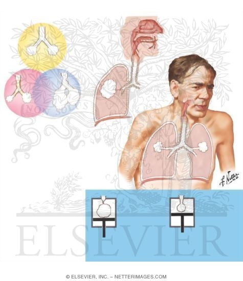 Chronic Obstructive Pulmonary Disease