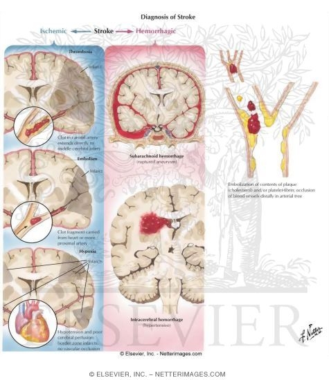 Diagnosis of Stroke