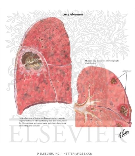 Lung Abscess