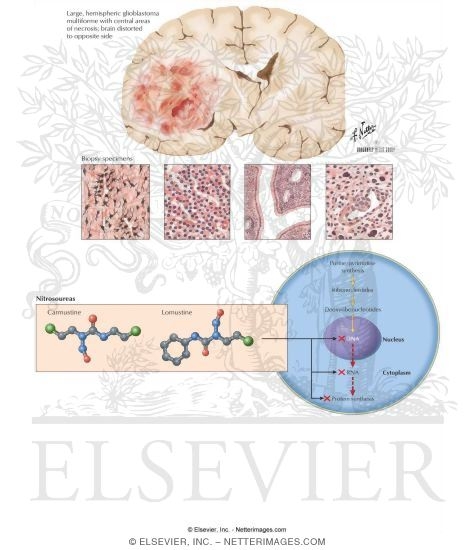 Nitrosoureas: Carmustine and Lomustine