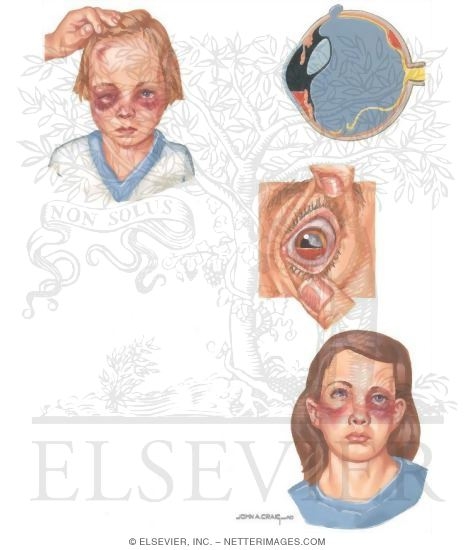 Child Abuse: Ocular and Adnexal Injuries