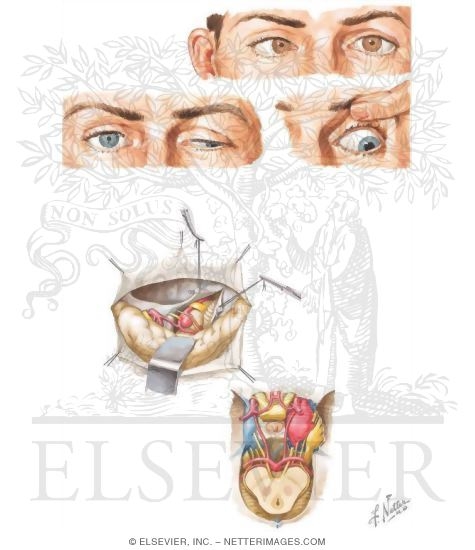 Aneurysm: Embolism Vs Aneurysm