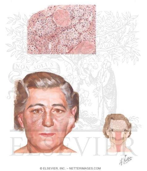 Types Of Parotid Gland Tumors Types Of Parotid Gland Tumors