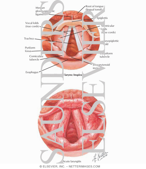 laryngitis diagram