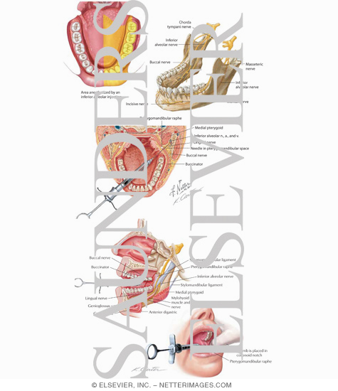 Inferior Alveolar Block Injection