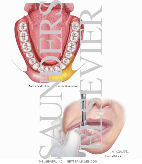 mental nerve block