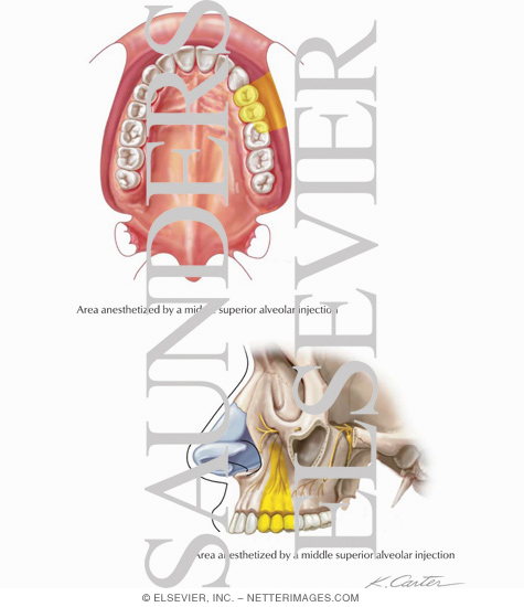 Maxillary Injections: Middle Superior Alveolar Nerve Block