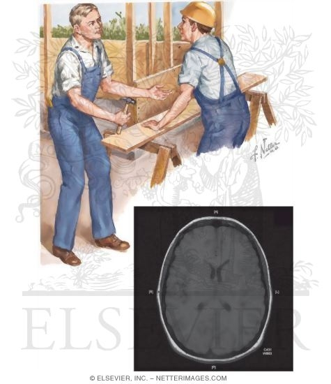 Transient Global Amnesia