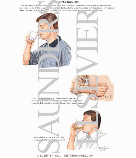 Essential Tremor