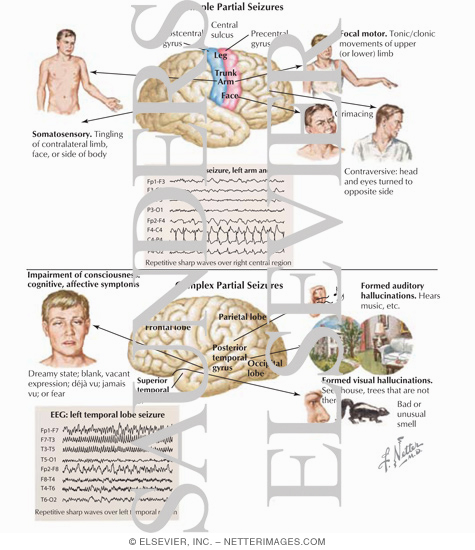 Parital Seizures