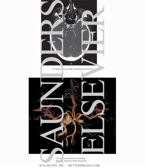 Subarachnoid Hemorrhage