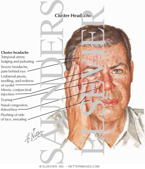 Cluster Headache