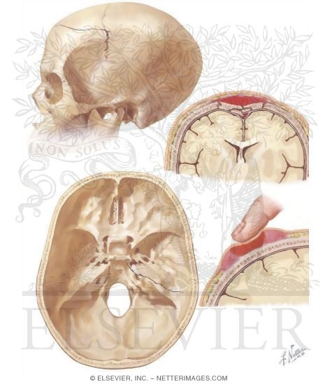 Basilar Skull Fracture Diagram