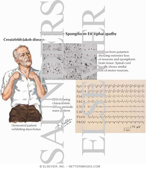 Prion Diseases