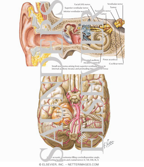 Acoustic Neuroma