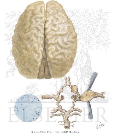 Cerebral Arteriosclerosis