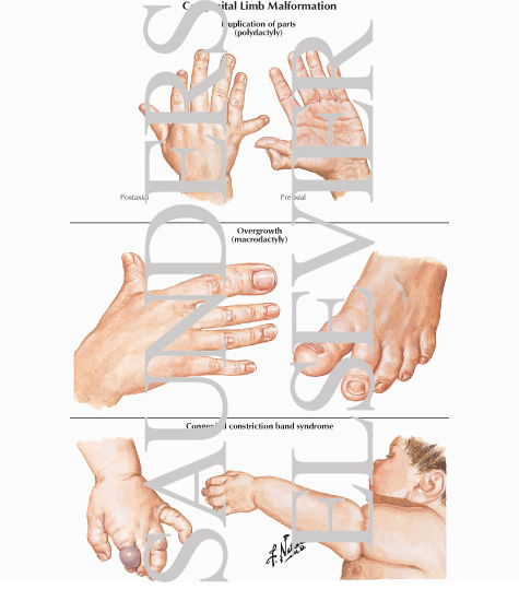 Duplication of Parts (polydactyly), Overgrowth (macrodactyly), and ...