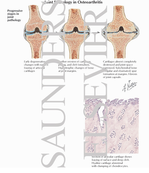 Joint Pathology in Osteoarthritis