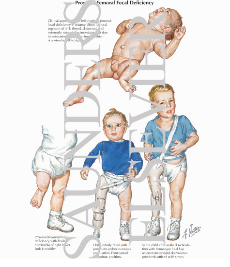 Proximal Femoral Focal Deficiency