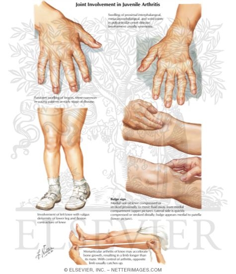 Joint Involvement In Juvenile Arthritis