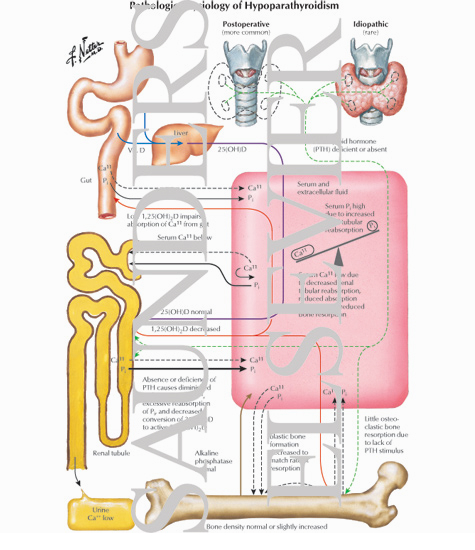Pathophysiology of Hypoparathyroidism