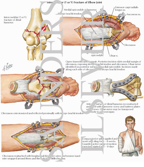Intercondylar (T or Y) Fracture of Elbow Joint