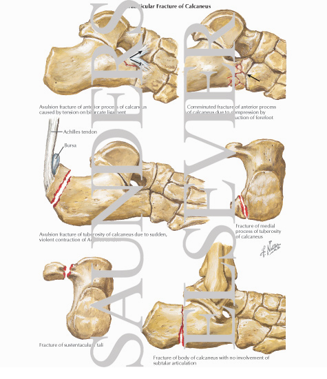 Calcaneus; Heel Bone