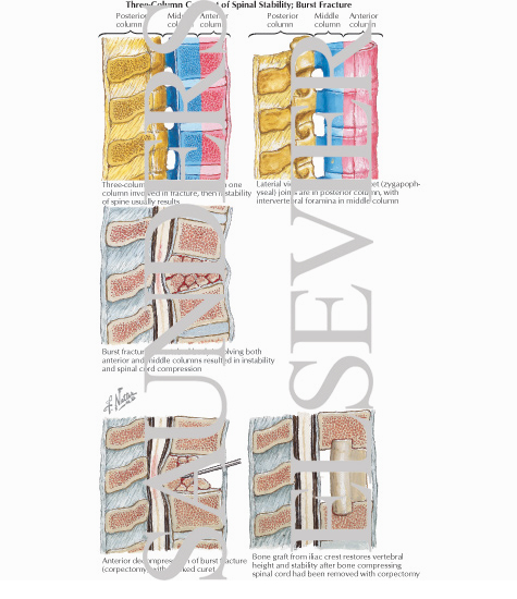 Three-Column Concept of Spinal Stability Trauma